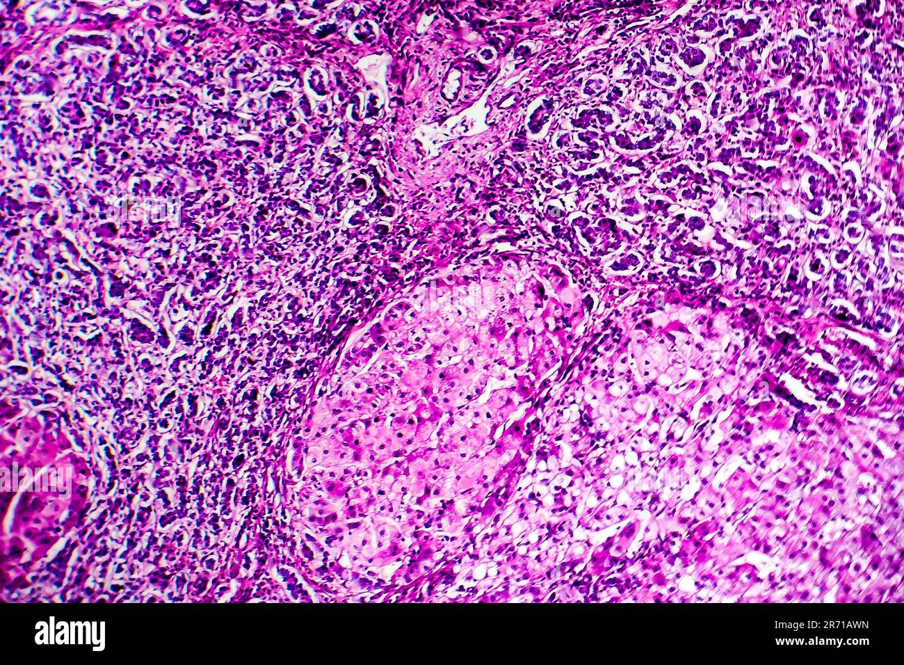 Histopathology of biliary liver cirrhosis, light micrograph, photo ...