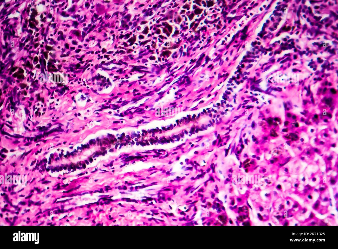 Histopathology of biliary liver cirrhosis, light micrograph, photo ...