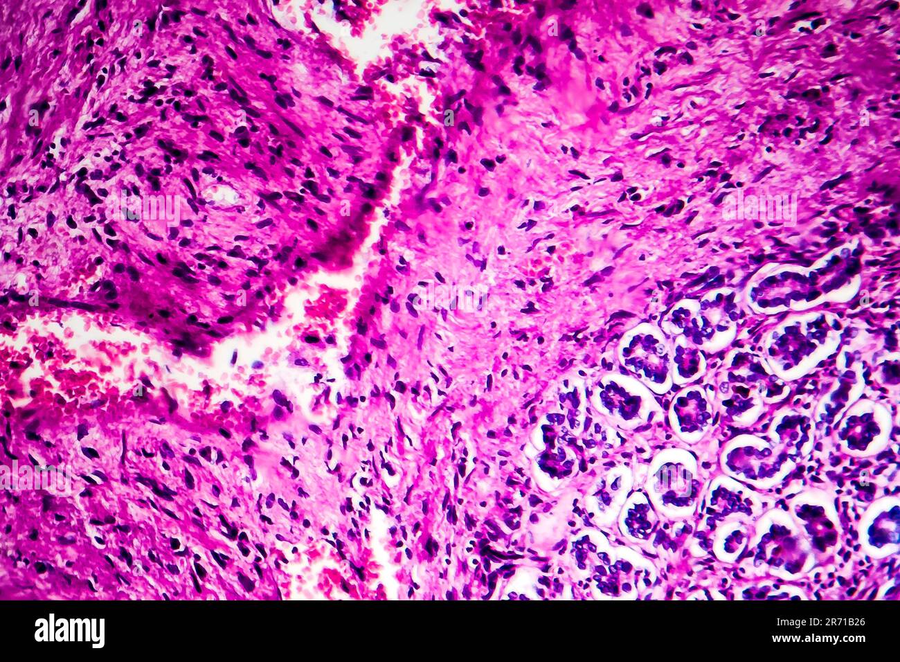 Histopathology of biliary liver cirrhosis, light micrograph, photo ...