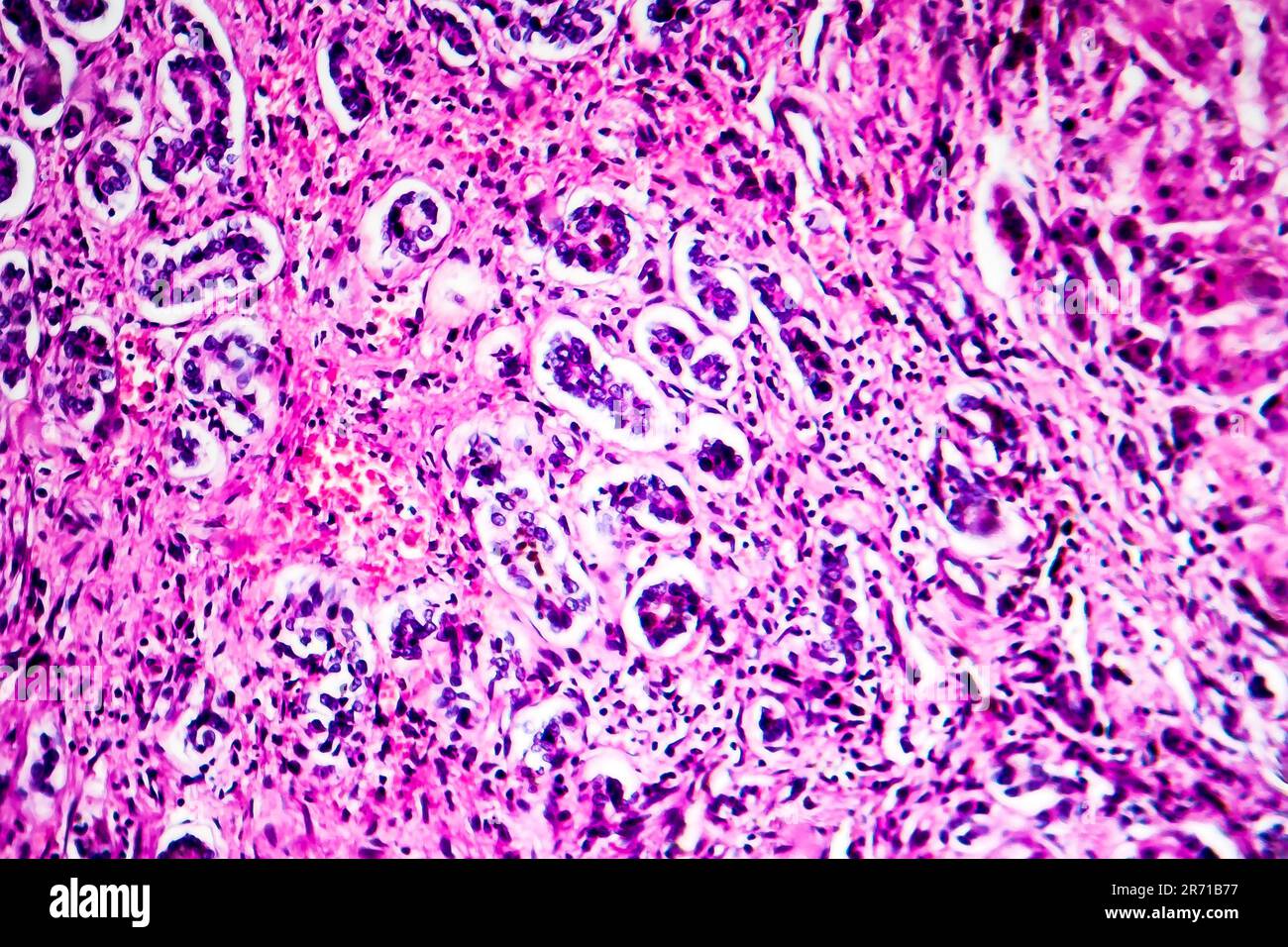 Histopathology of biliary liver cirrhosis, light micrograph, photo ...