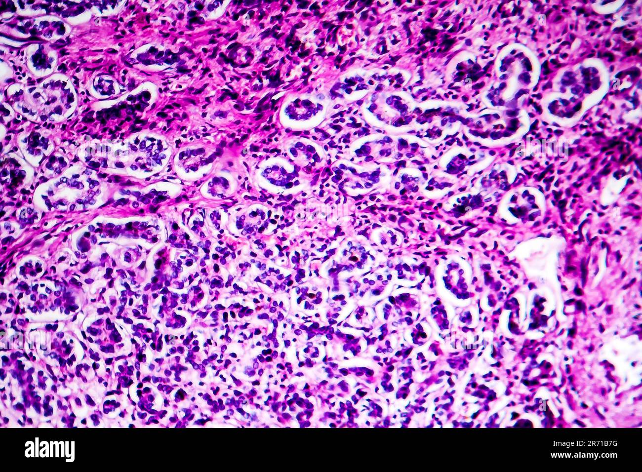 Histopathology of biliary liver cirrhosis, light micrograph, photo ...