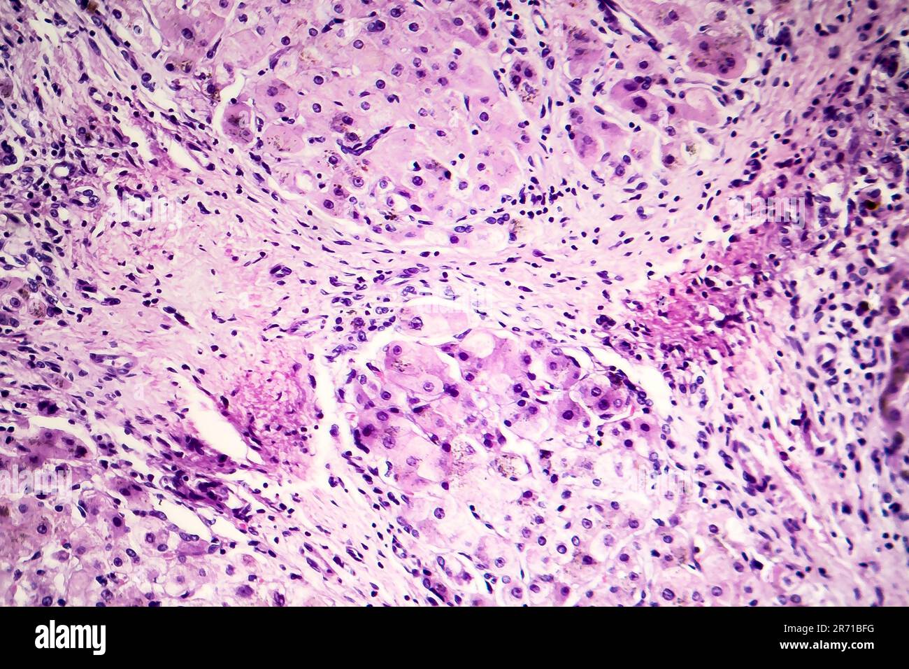 Histopathology of postnecrotic liver cirrhosis, light micrograph, photo ...