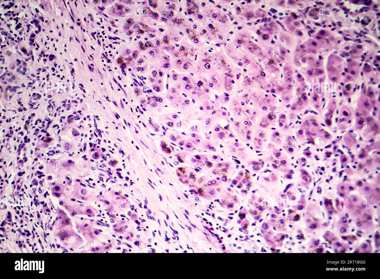 Histopathology of postnecrotic liver cirrhosis, light micrograph, photo ...