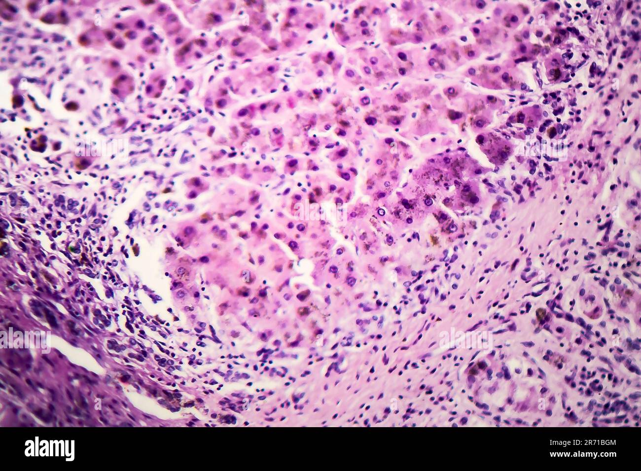 Histopathology of postnecrotic liver cirrhosis, light micrograph, photo ...