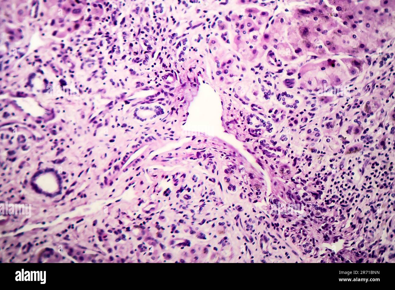 Histopathology of postnecrotic liver cirrhosis, light micrograph, photo ...