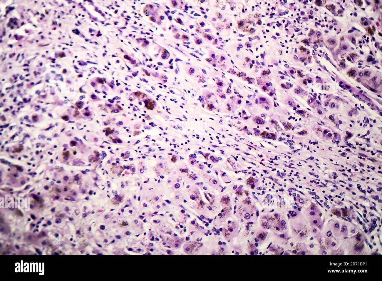 Necrotic liver hi-res stock photography and images - Alamy