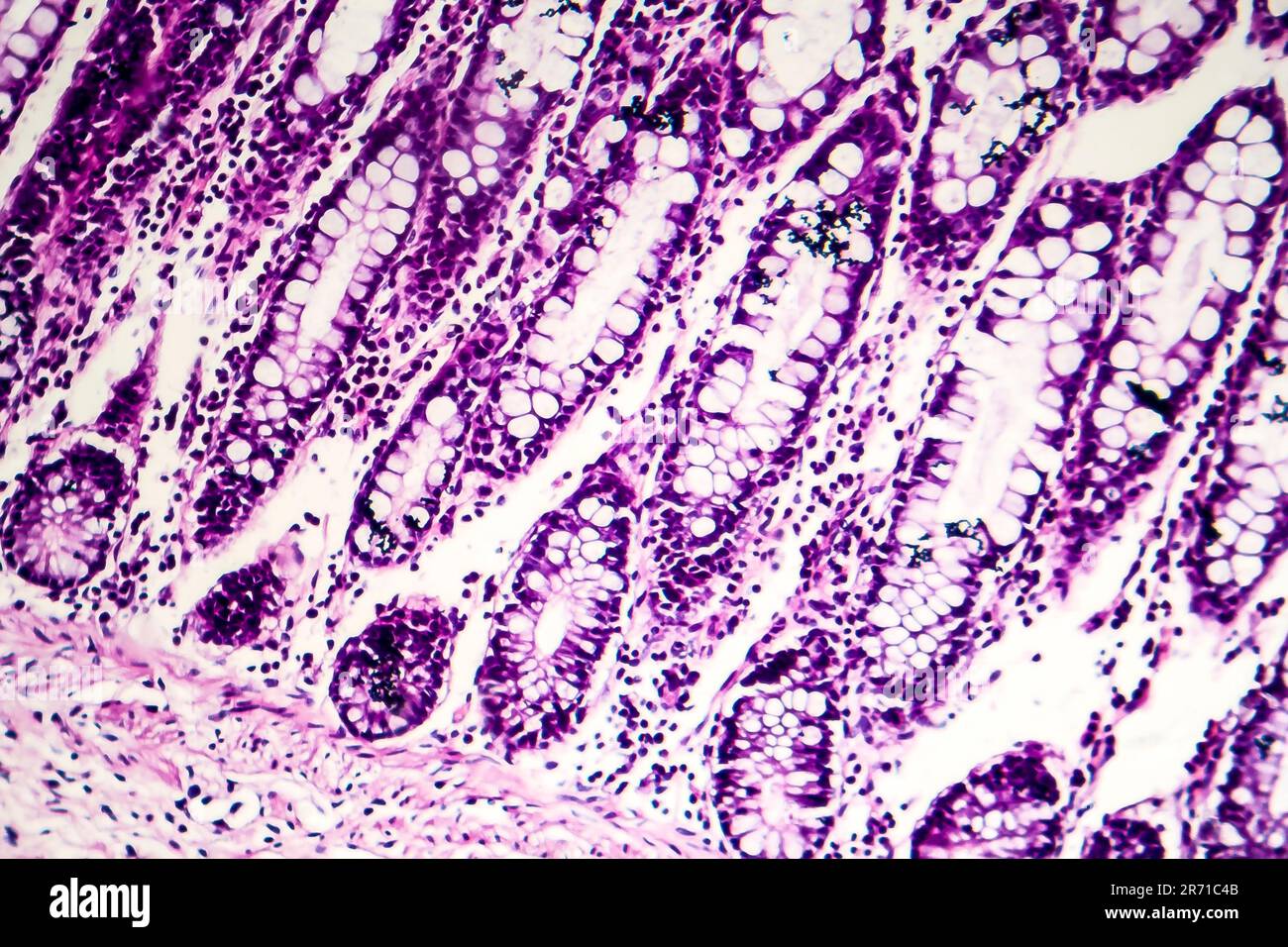 Bacillary dysentery, light micrograph, photo under microscope showing ...
