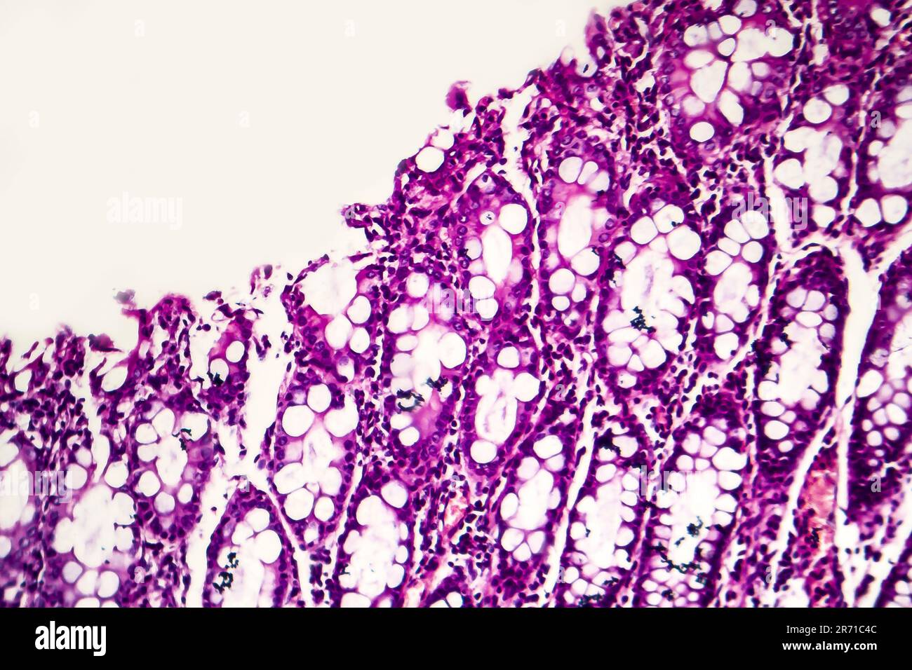 Bacillary dysentery, light micrograph, photo under microscope showing ...