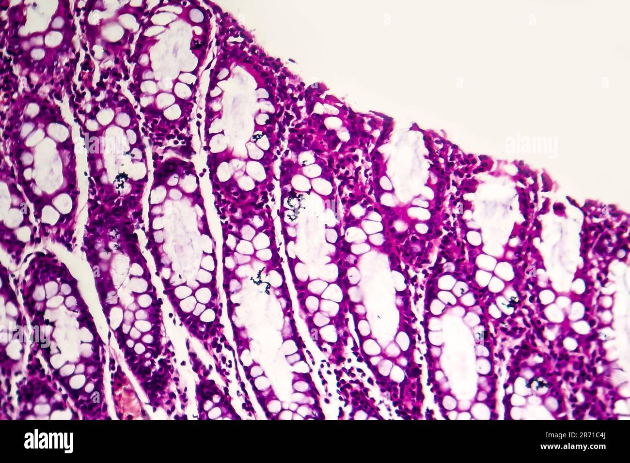 Bacillary dysentery, light micrograph, photo under microscope showing ...