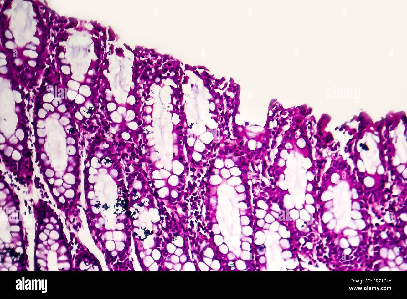 Bacillary dysentery, light micrograph, photo under microscope showing ...