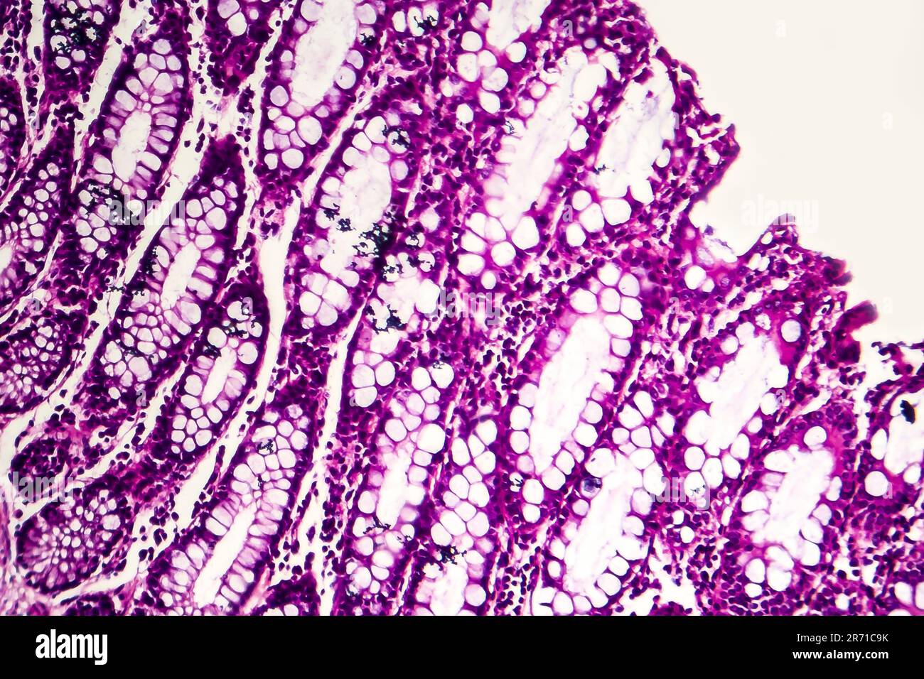 Bacillary dysentery, light micrograph, photo under microscope showing ...