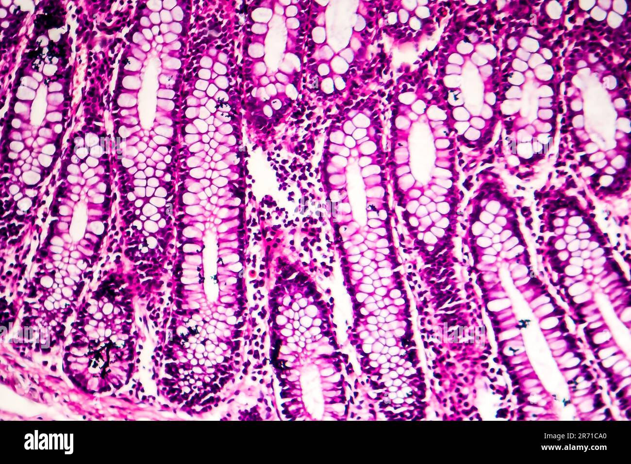 Bacillary dysentery, light micrograph, photo under microscope showing ...