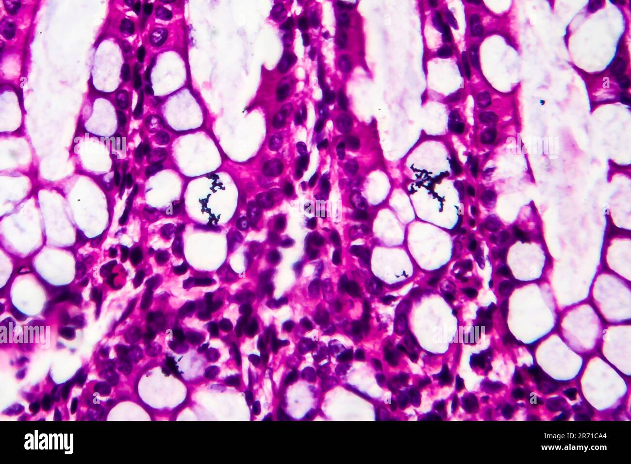 Bacillary dysentery, light micrograph, photo under microscope showing ...