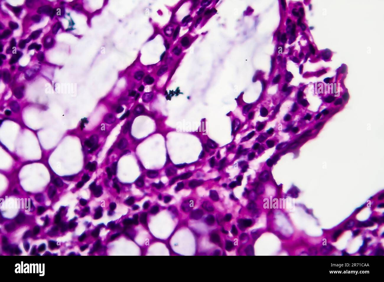 Bacillary dysentery, light micrograph, photo under microscope showing ...