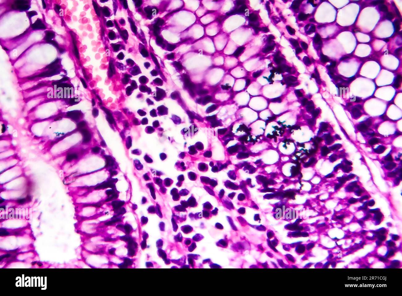 Bacillary dysentery, light micrograph, photo under microscope showing ...