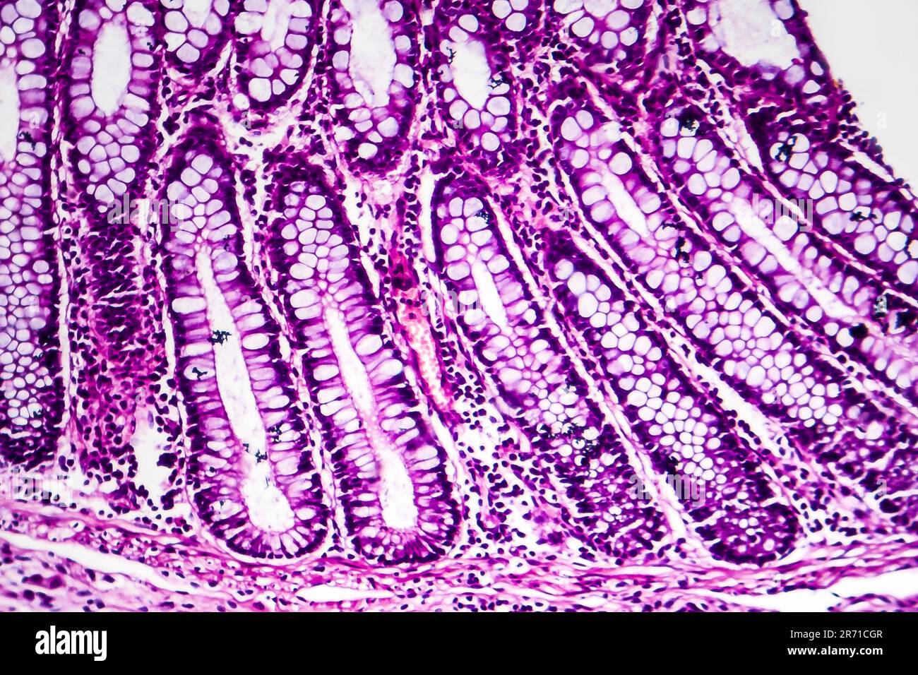 Bacillary dysentery, light micrograph, photo under microscope showing ...