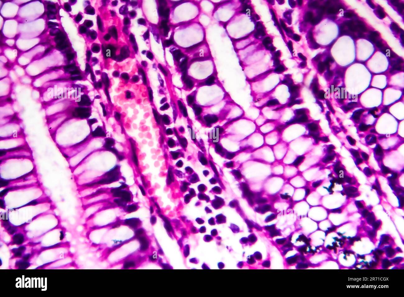 Bacillary dysentery, light micrograph, photo under microscope showing ...