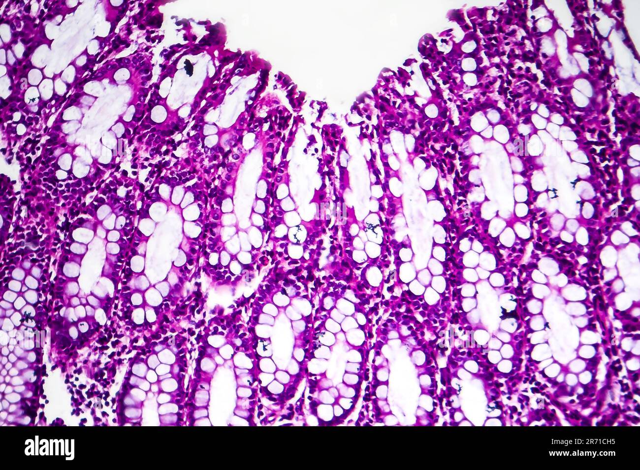 Bacillary dysentery, light micrograph, photo under microscope showing ...
