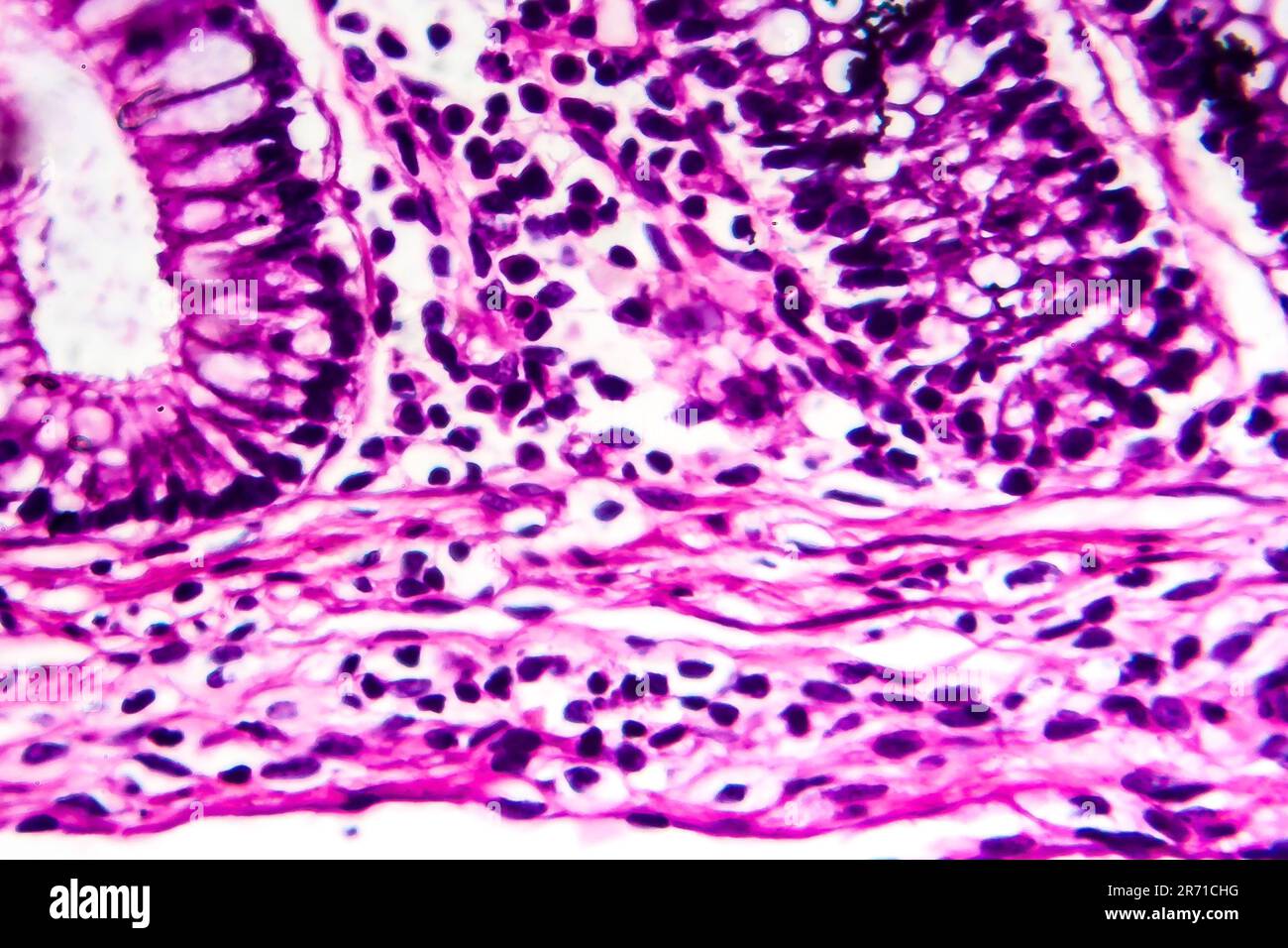 Bacillary dysentery, light micrograph, photo under microscope showing ...