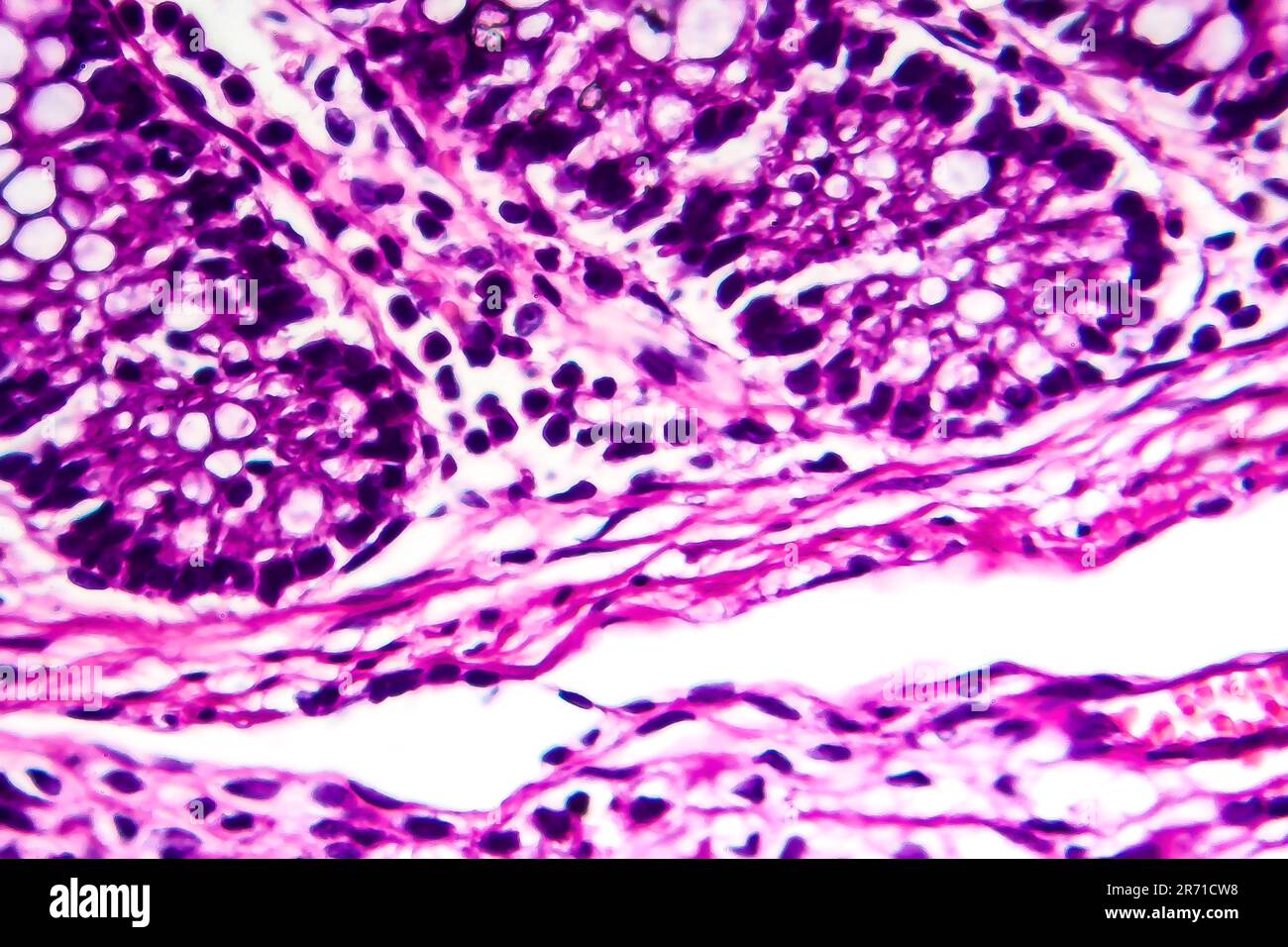 Bacillary dysentery, light micrograph, photo under microscope showing ...