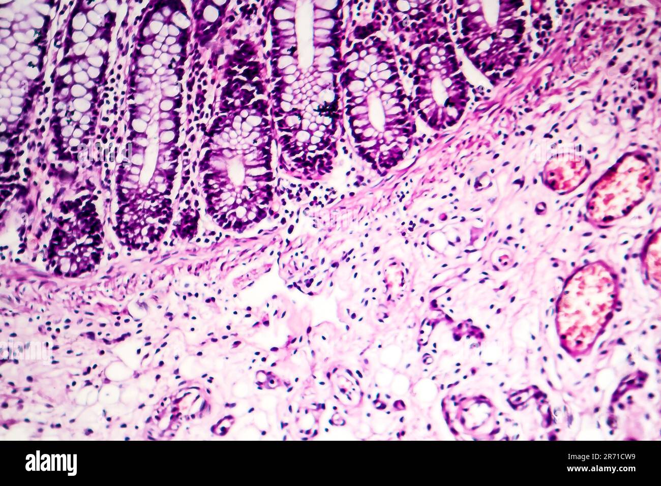 Bacillary dysentery, light micrograph, photo under microscope showing ...