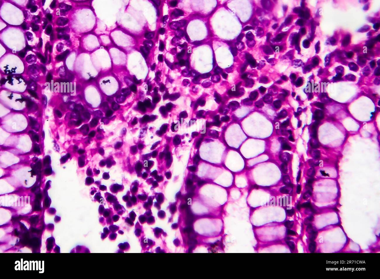 Bacillary dysentery, light micrograph, photo under microscope showing ...