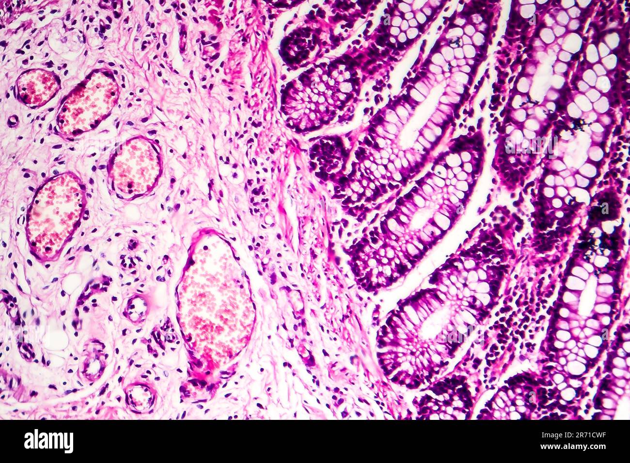 Bacillary dysentery, light micrograph, photo under microscope showing ...