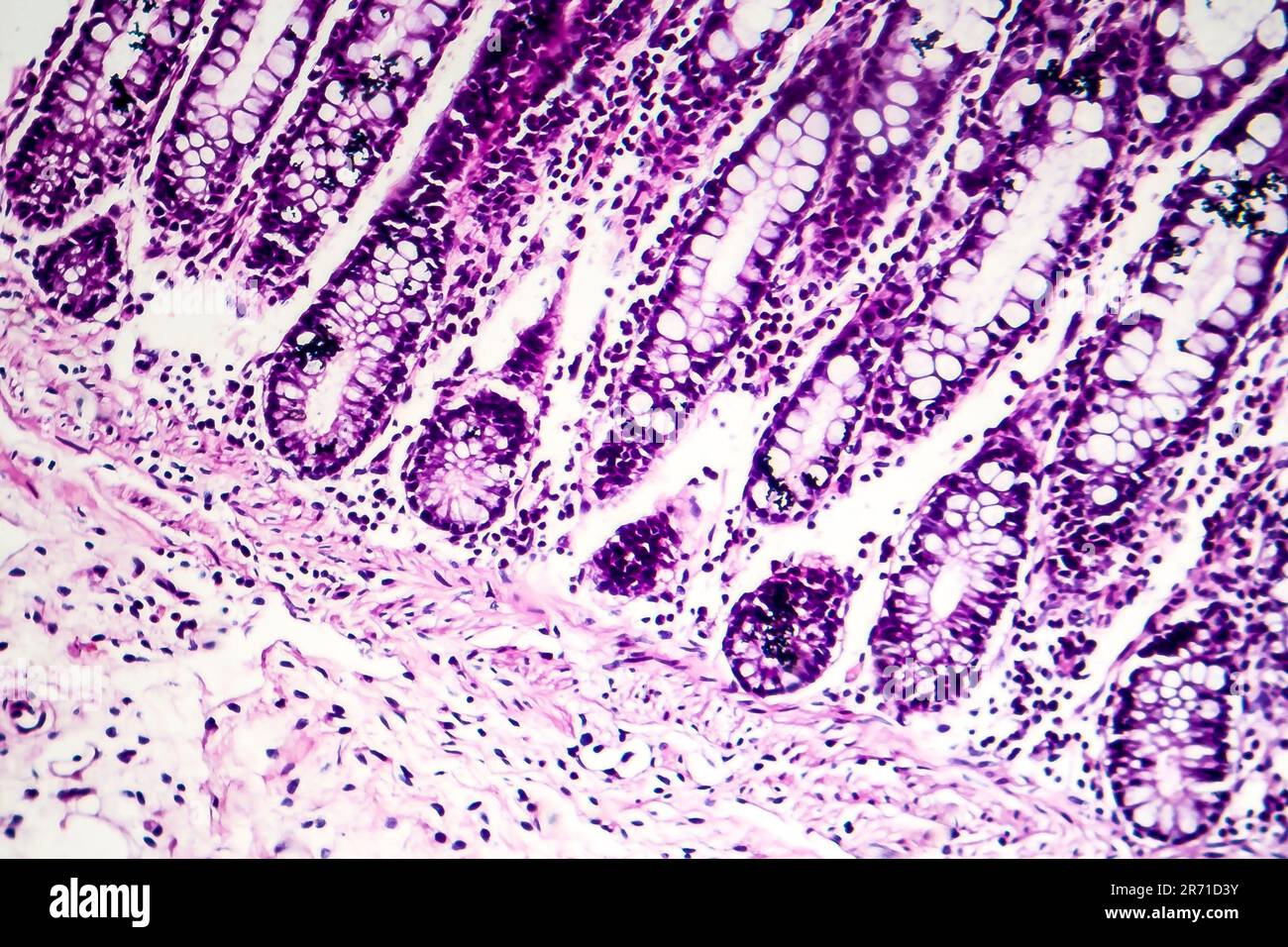 Bacillary dysentery, light micrograph, photo under microscope showing ...
