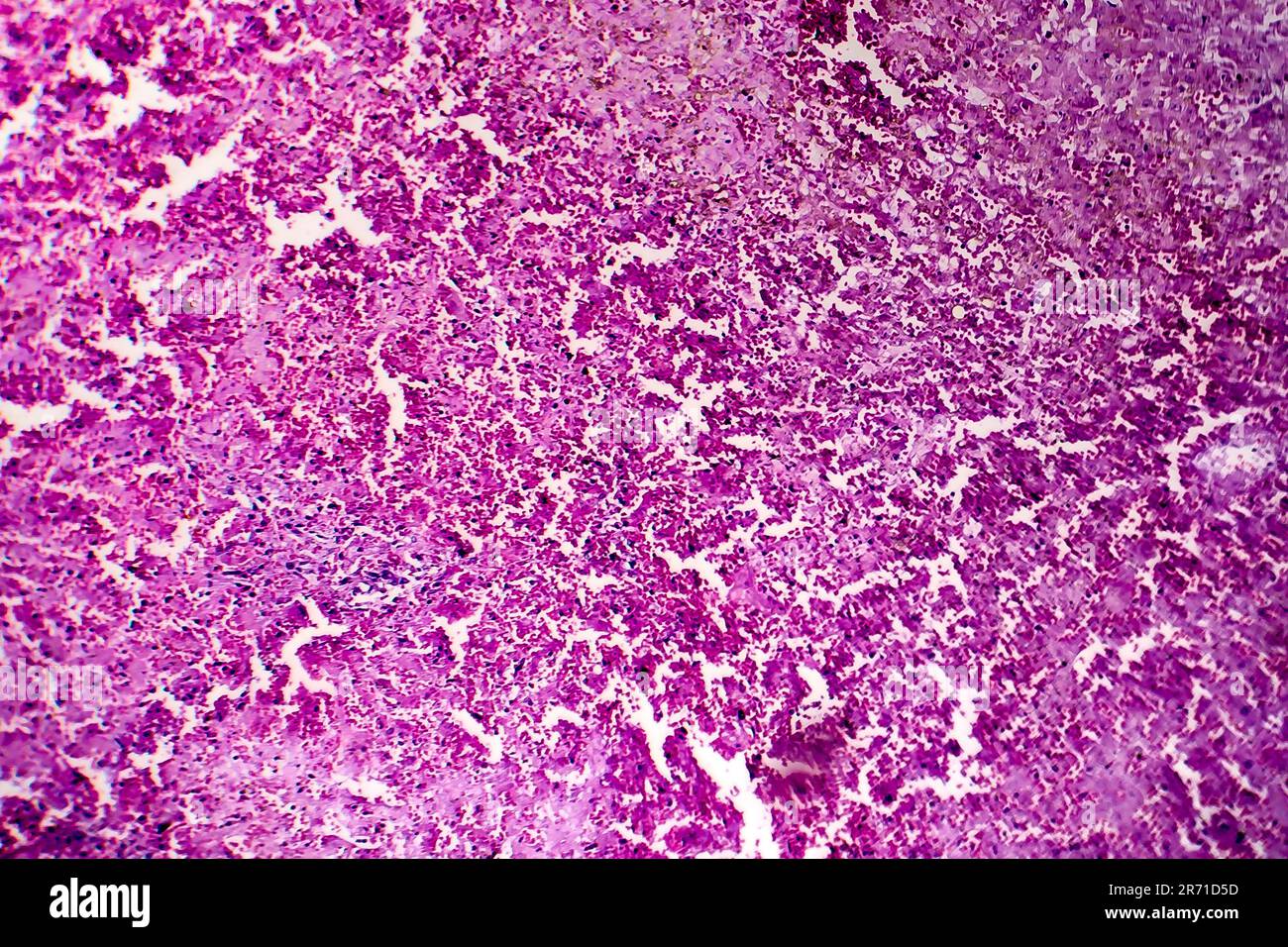 Hepatic congestion, light micrograph, photo under microscope Stock ...