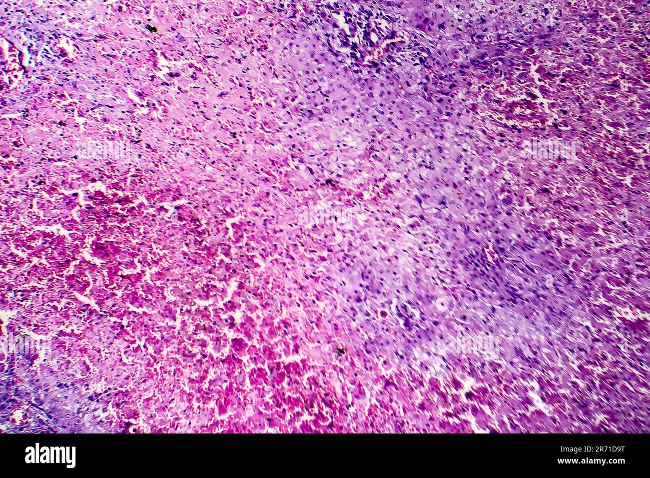 Hepatic congestion, light micrograph, photo under microscope Stock ...