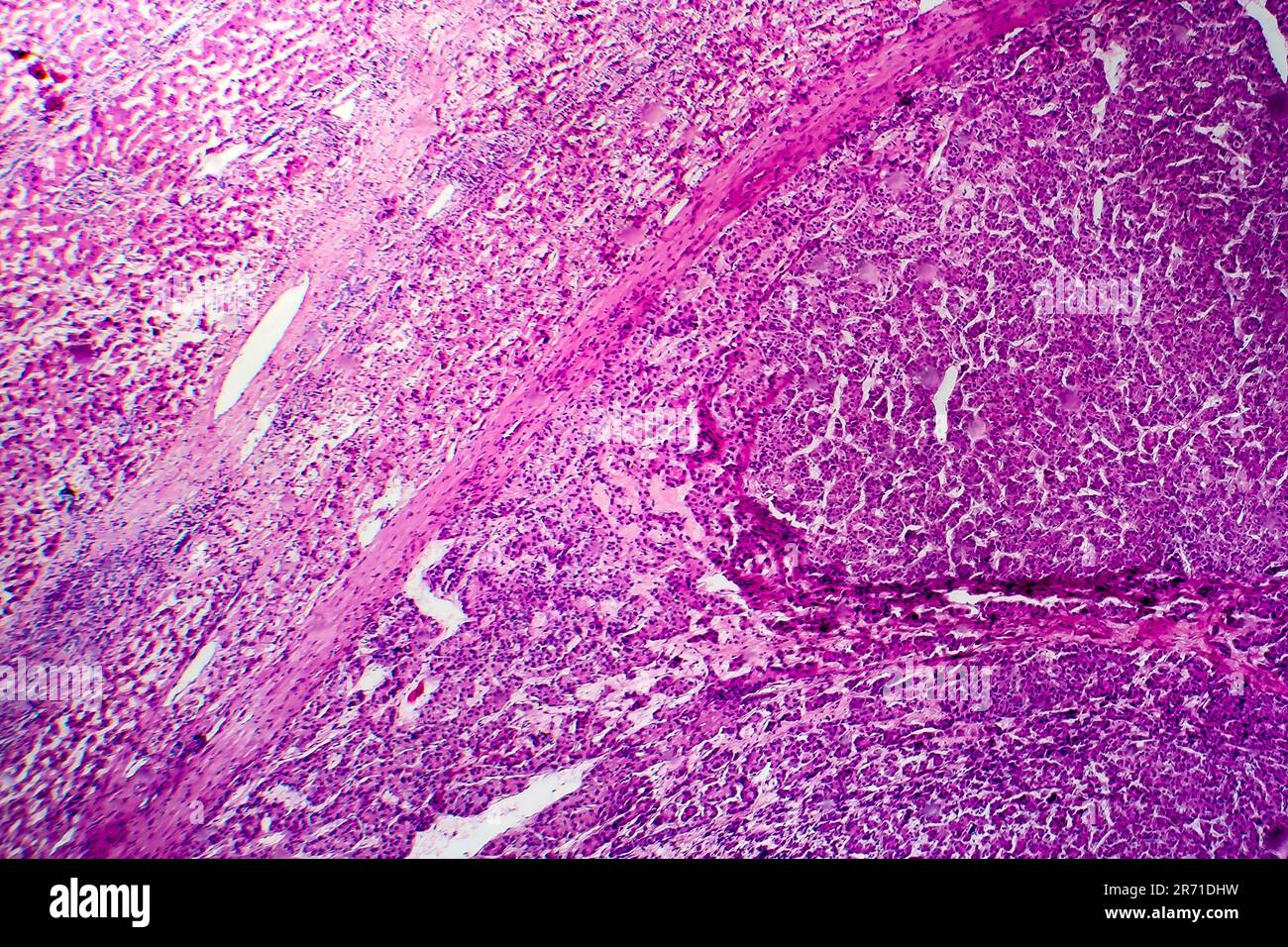Hepatocellular carcinoma, cancer of liver, light micrograph, photo ...