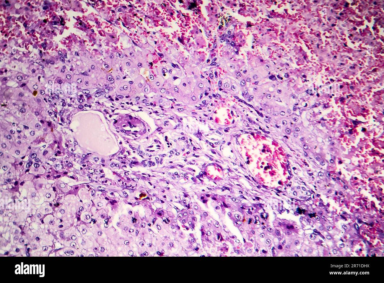 Hepatic congestion of liver hi-res stock photography and images - Alamy