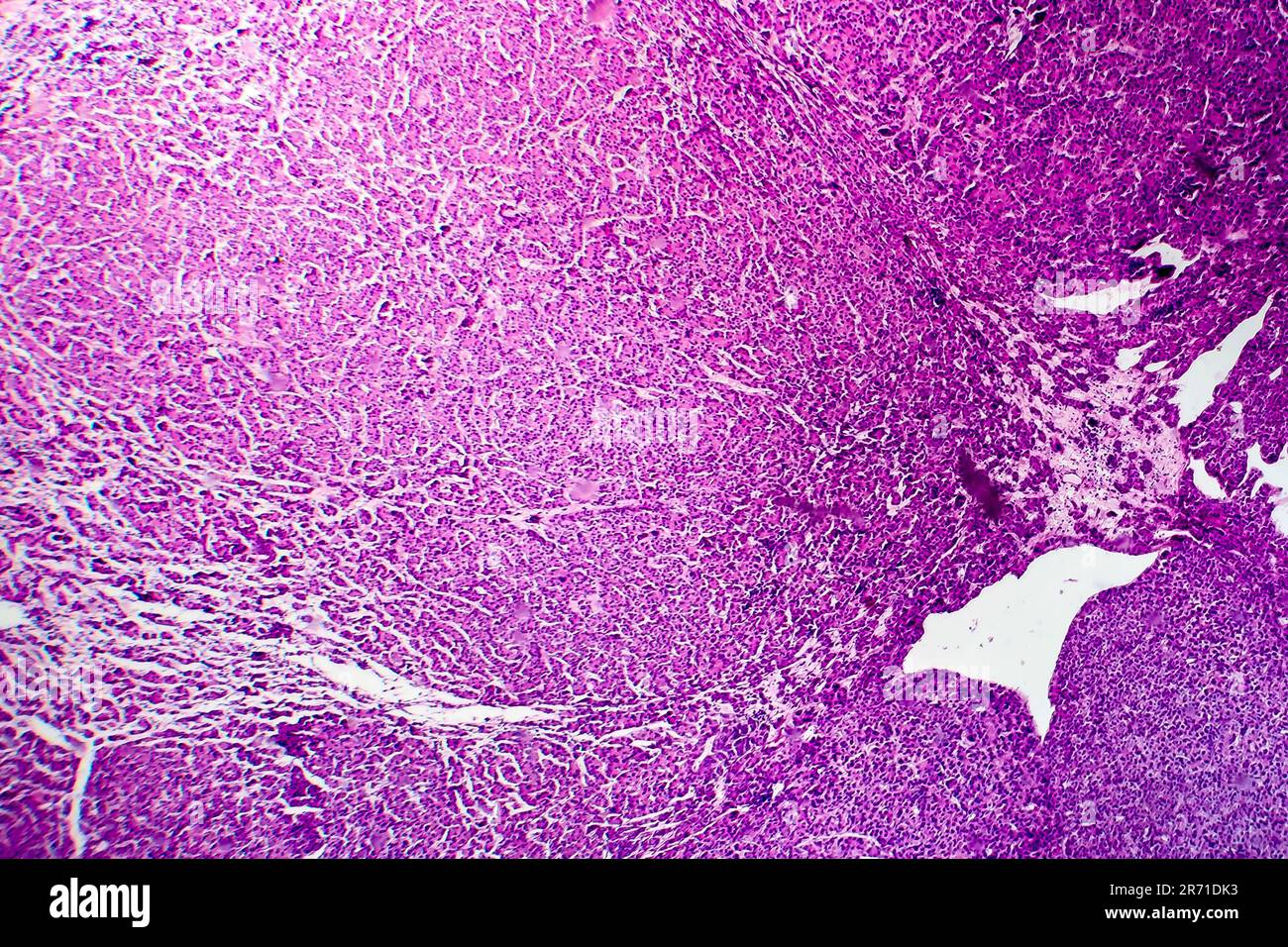 Hepatocellular carcinoma, cancer of liver, light micrograph, photo ...