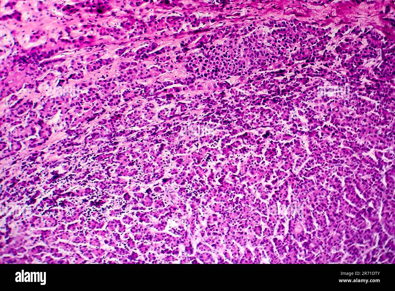 Hepatocellular carcinoma, cancer of liver, light micrograph, photo ...
