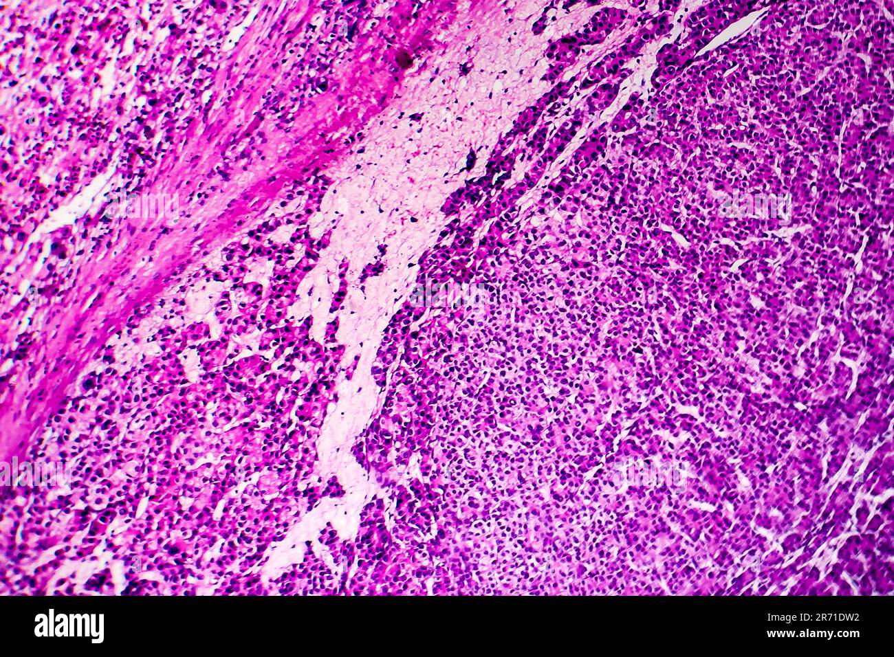Hepatocellular carcinoma, cancer of liver, light micrograph, photo ...