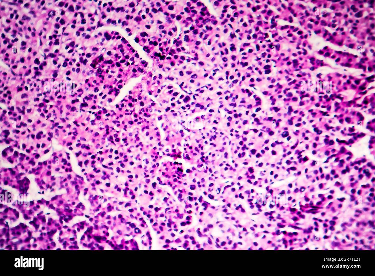 Liver neoplasm hi-res stock photography and images - Alamy