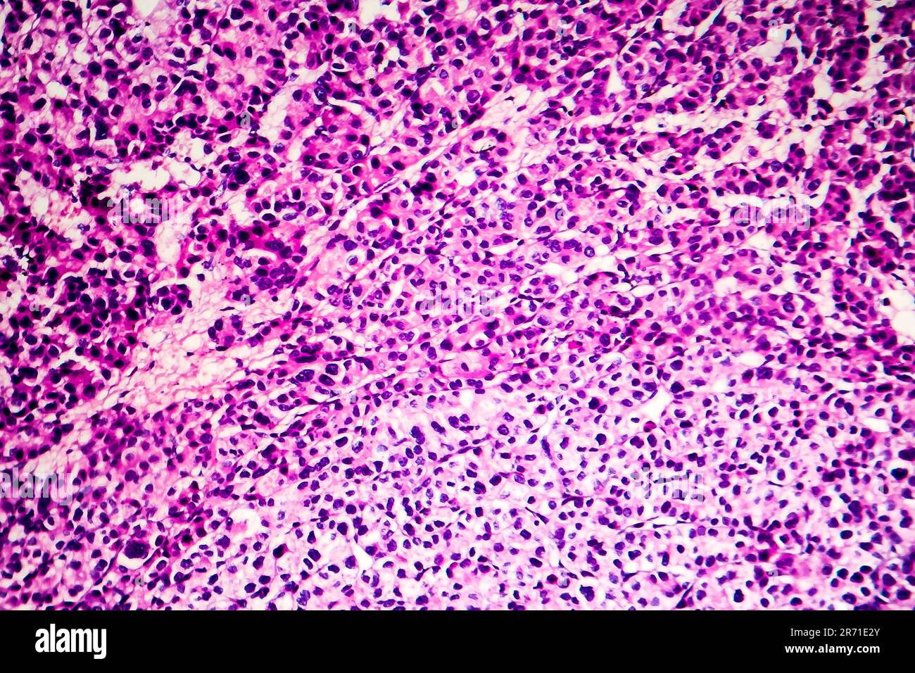 Hepatocellular carcinoma, cancer of liver, light micrograph, photo ...