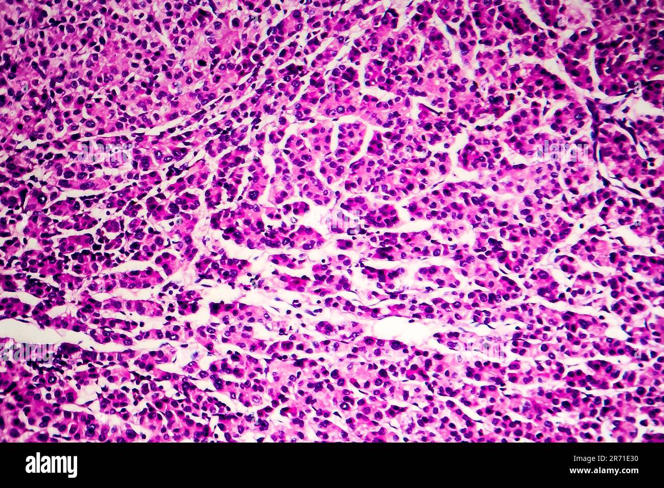 Hepatocellular carcinoma, cancer of liver, light micrograph, photo ...