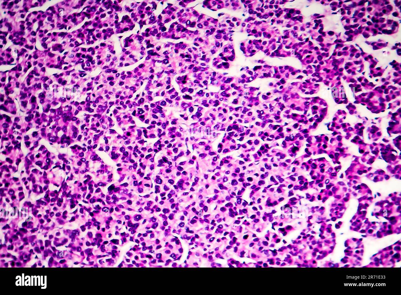 Hepatocellular carcinoma, cancer of liver, light micrograph, photo ...