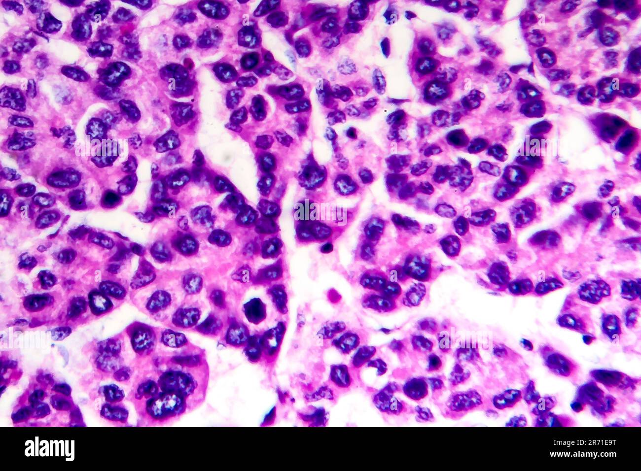 Hepatocellular carcinoma, cancer of liver, light micrograph, photo ...