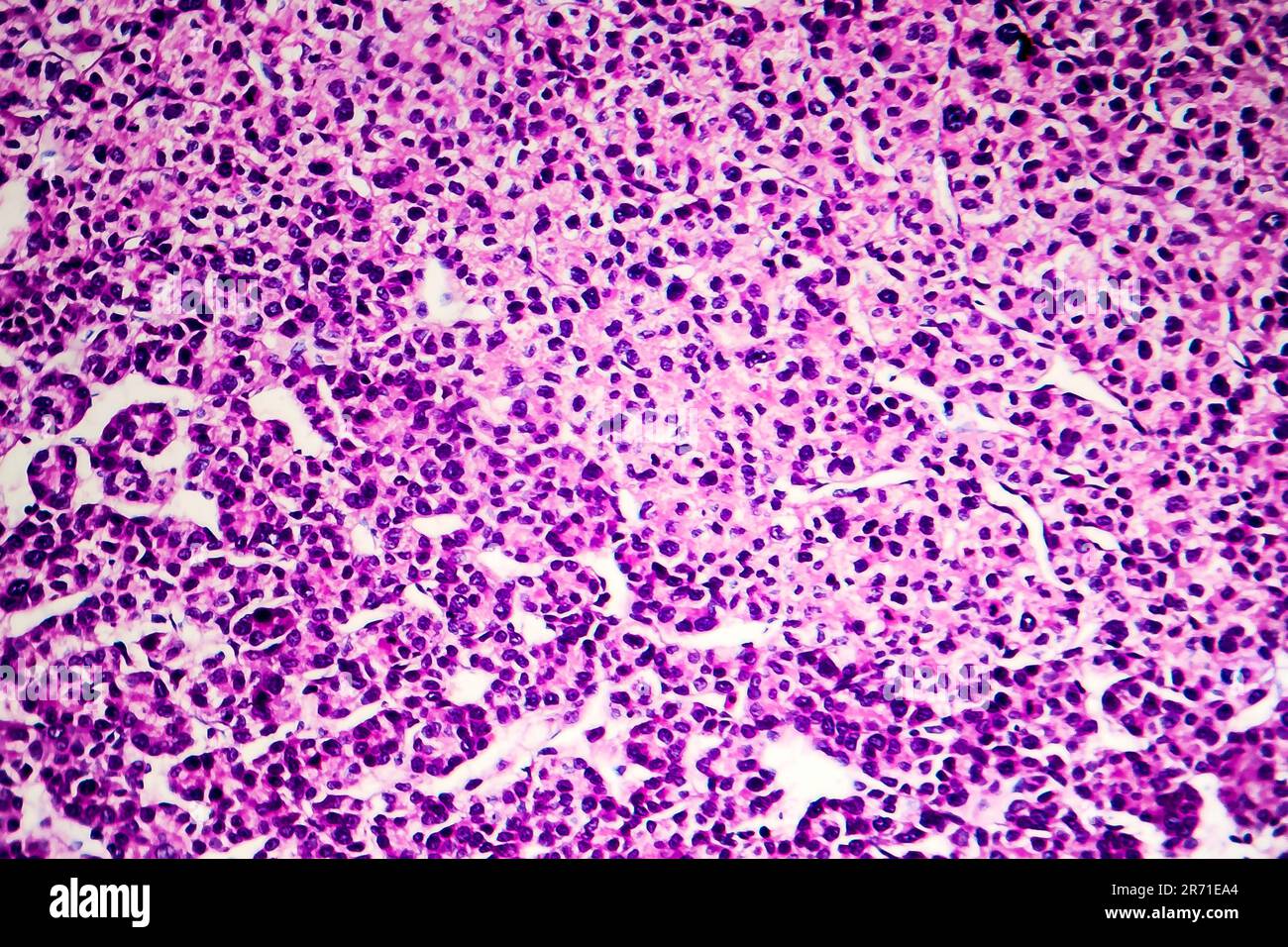 Hepatocellular carcinoma, cancer of liver, light micrograph, photo ...