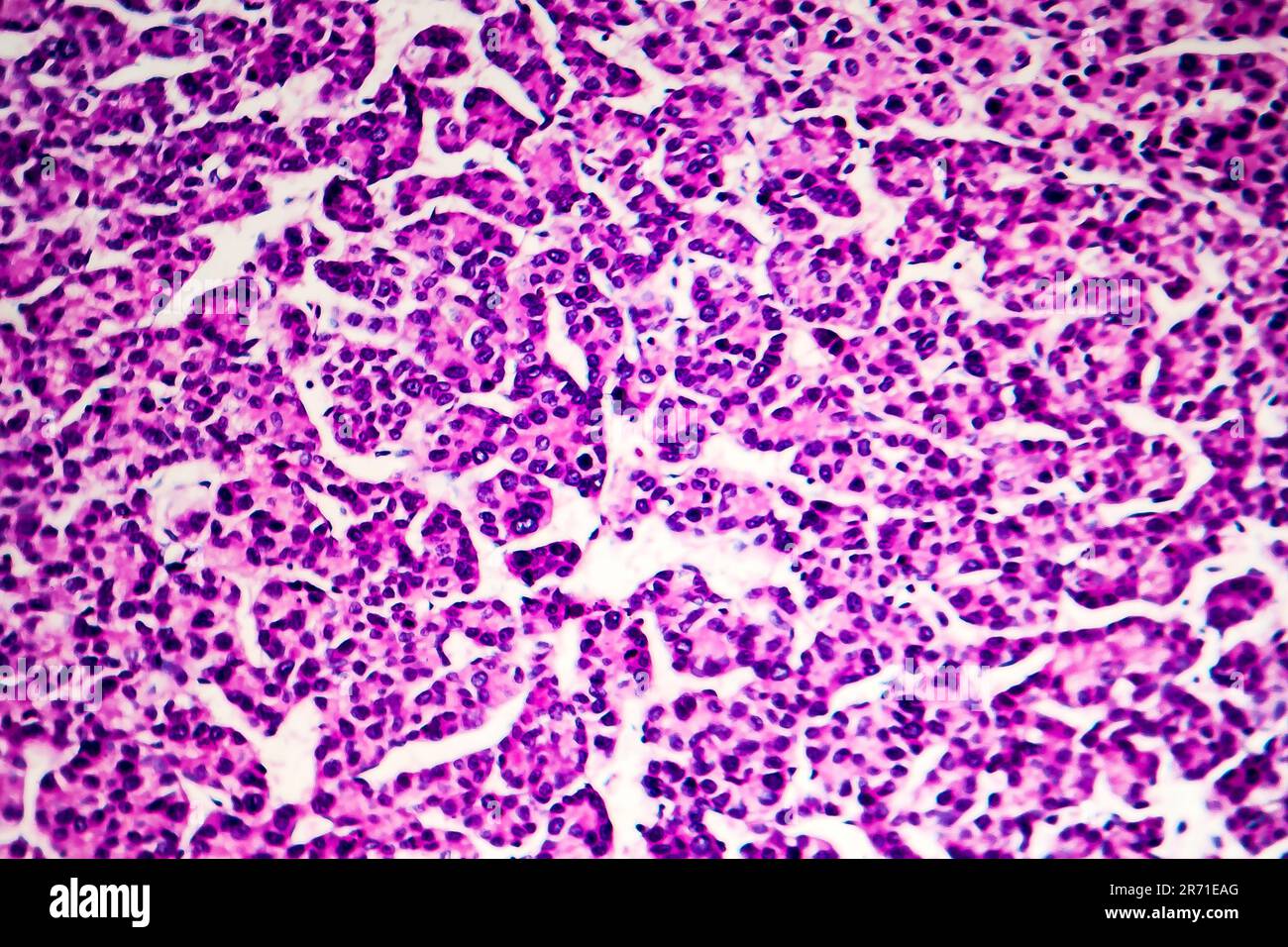 Liver neoplasm hi-res stock photography and images - Alamy