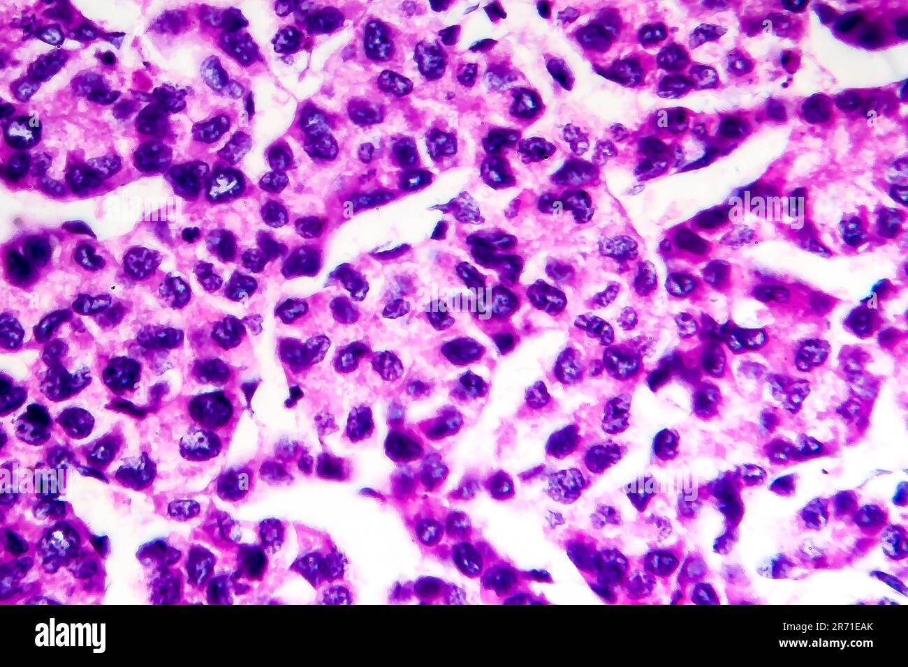 Hepatocellular carcinoma, cancer of liver, light micrograph, photo ...