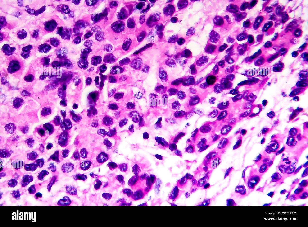 Liver neoplasm hi-res stock photography and images - Alamy