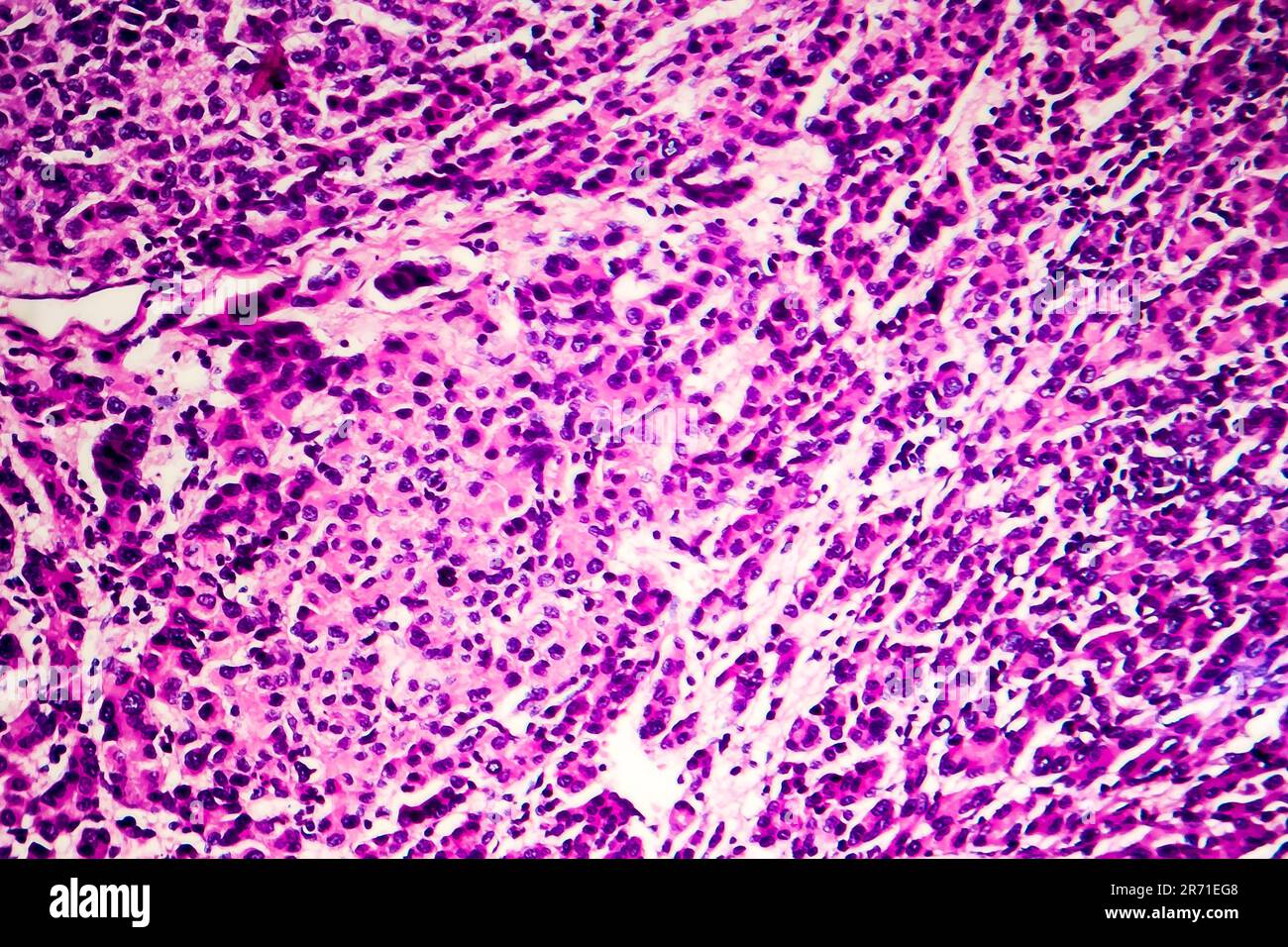 Liver neoplasm hi-res stock photography and images - Alamy