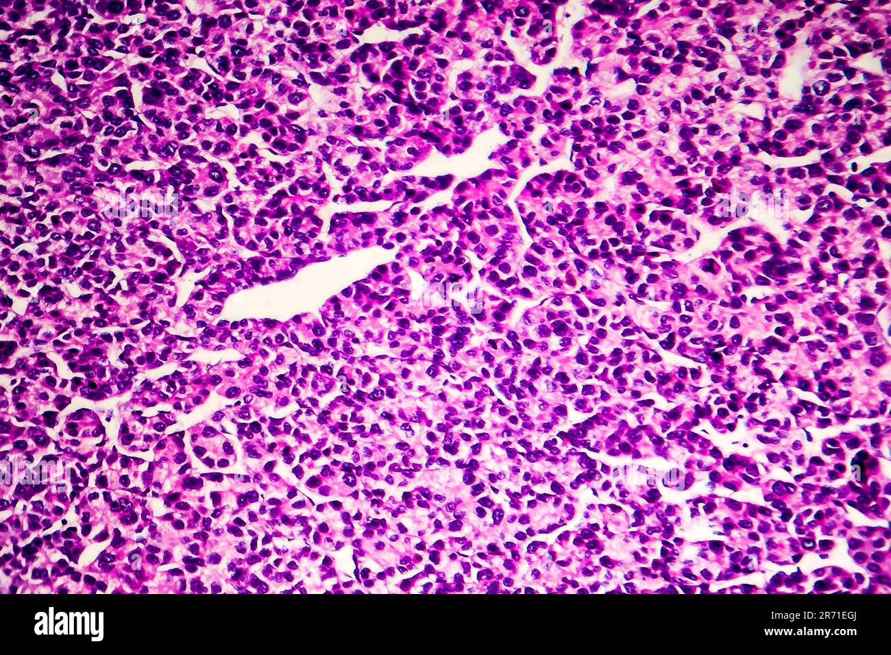 Hepatocellular carcinoma, cancer of liver, light micrograph, photo ...