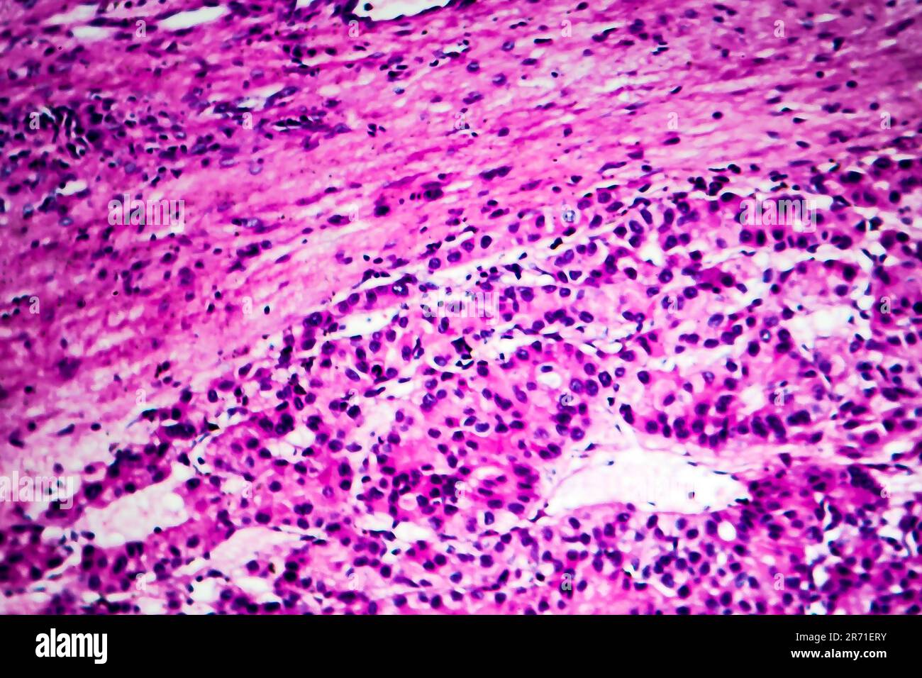 Hepatocellular carcinoma, cancer of liver, light micrograph, photo ...
