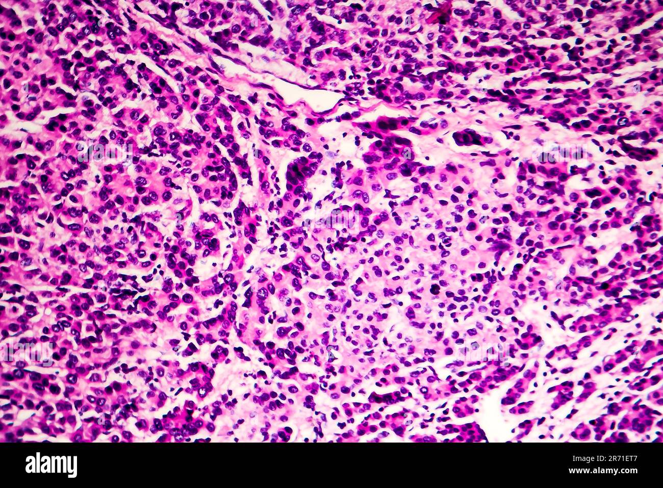 Liver neoplasm hi-res stock photography and images - Alamy