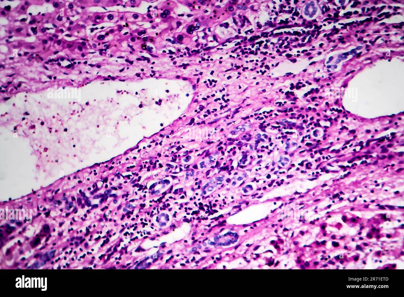 Hepatocellular carcinoma, cancer of liver, light micrograph, photo ...