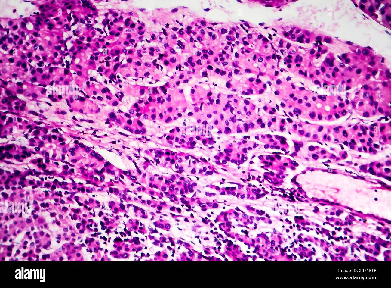 Hepatocellular carcinoma, cancer of liver, light micrograph, photo ...